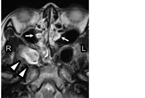 Axial T2 Weighted Follow Up Mr Image 1 Month After Onset This Mr Image