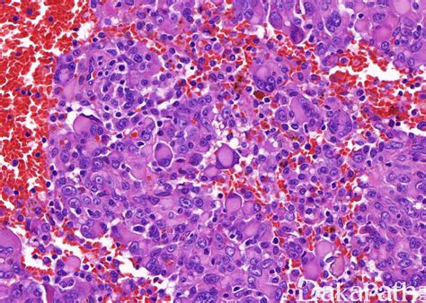 血管瘤样纤维组织细胞瘤