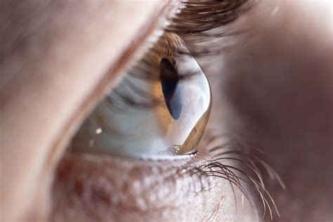 5 Things Every Person With Keratoconus Should Know — Contact Lens