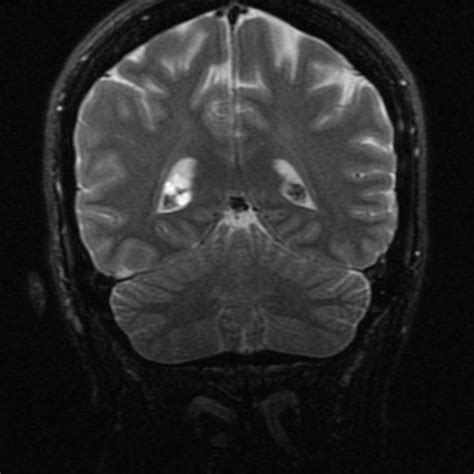 Plexus Choroideus Schafgehirn