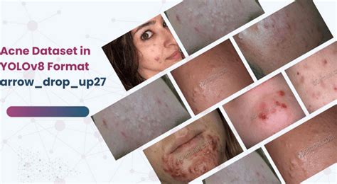 Acne Dataset In Yolov8 Format Ai Data Collection Company