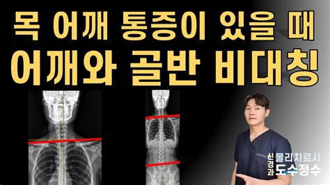 어깨 높이 차이와 골반 틀어짐 실제 사례로 보는 체형 엑스레이 Youtube