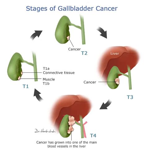 Best Gallbladder Cancer Treatment In Ahmedabad India