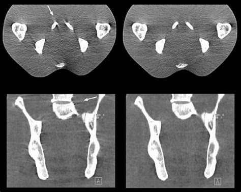 Cone Beam Artifact Radiology The Best Picture Of Beam