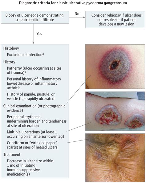 Diagnostic Criteria Of Ulcerative Pyoderma Gangrenosum A Delphi