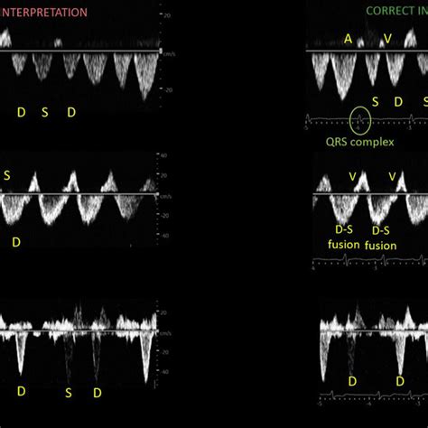 Pulsed Wave Doppler Tracing Of The A Hepatic Vein And B Portal