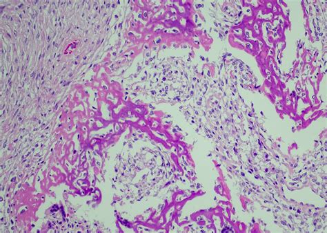 Six Figure Settlement For 18 Year Delay In Diagnosing Osteosarcoma In Forearm