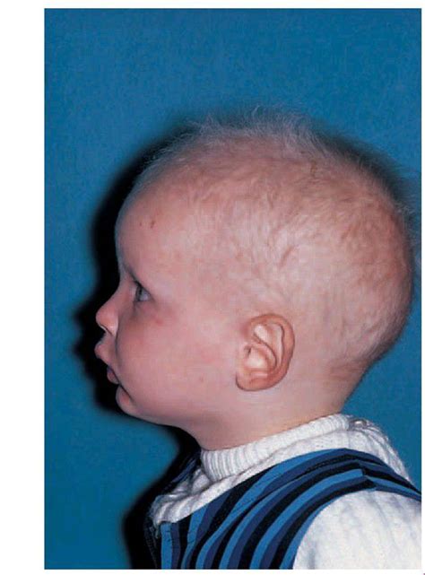 Hereditary Ectodermal Dysplasia Medizzy