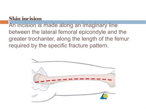 Teknik Operasi Orif Femur Ppt