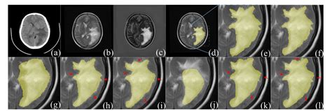 Figure 1 From Multimodal Glioma Image Segmentation Using Dual Encoder