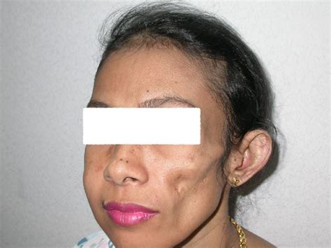 Lupus Profundus Panniculitis Lupus Erythematosus Panniculitis Lupus Panniculitis