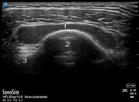 Shoulder Transverse Subacromial Bursitis Image Sonosite Institute For Point Of Care Ultrasound