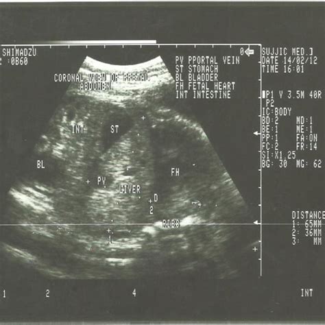 Pdf Relationship Of Fetal Liver Volume With Estimated Fetal Weight And Gestational Age A 2