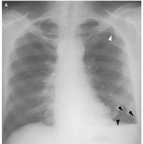 Hemopneumothorax A Hemothorax And Pneumothorax Seen On