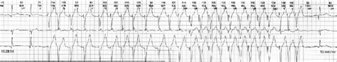 Pacemaker Mediated Tachycardia Interpolated Into Ventricular