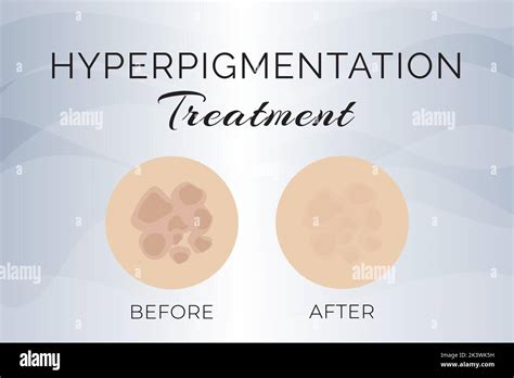 Hyperpigmentation Treatment Before And After Illustration Design Stock Vector Image And Art Alamy