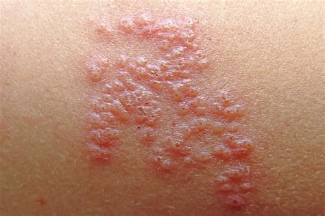 Non Contagious Skin Conditions Bumps Rashes Moles And More
