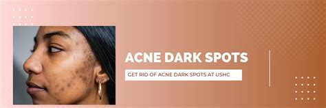 Acne Dark Spots Types Causes Symptoms And Treatment