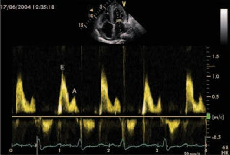 Transmitral Doppler Flow Showed A Restrictive Filling Pattern With Ea