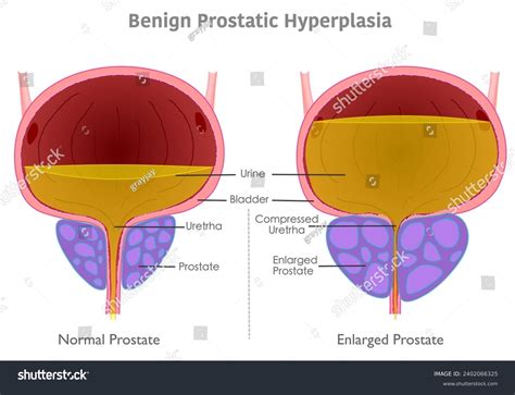 Benign Prostatic Hyperplasia Anatomy Enlarged Normal Stock Vector Royalty Free 2402066325