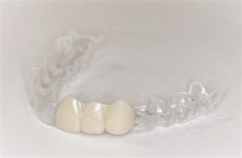 Dental Care While Wearing An Essix Retainer The Pankey Institute