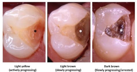 Management Of Deep Caries Flashcards Quizlet