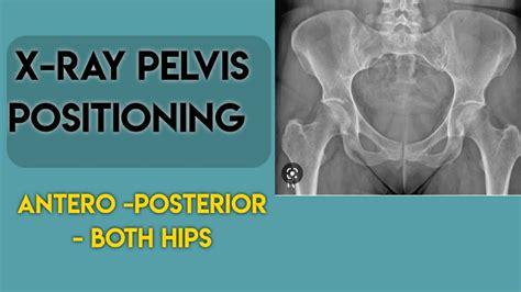 What Can A Hip X Ray Detect At Jarrod Guerra Blog