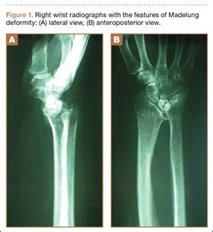 Madelung Deformity And Extensor Tendon Rupture Mdedge Surgery