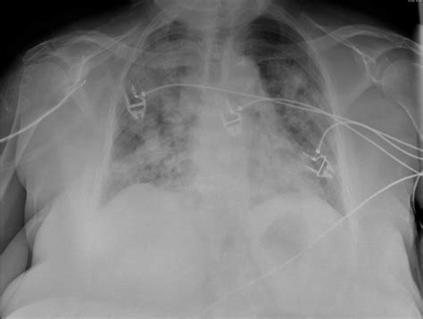 Heres A Physiology Case That Everyone Who Touches A Ventilator Needs To Understand A 60 Yo