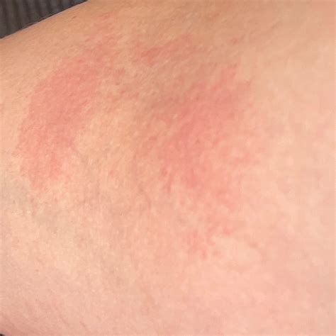 Dermatitis Icd 10 L20 ⚠️ Online Ai Dermatologist