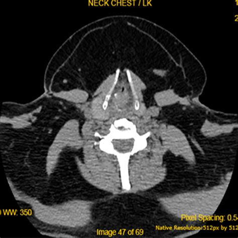 Diffuse Lipomatosis On Ct Scan Download Scientific Diagram