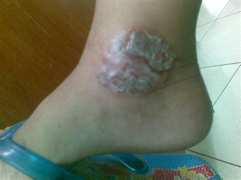 Kesehatan Dermatitis Numularis