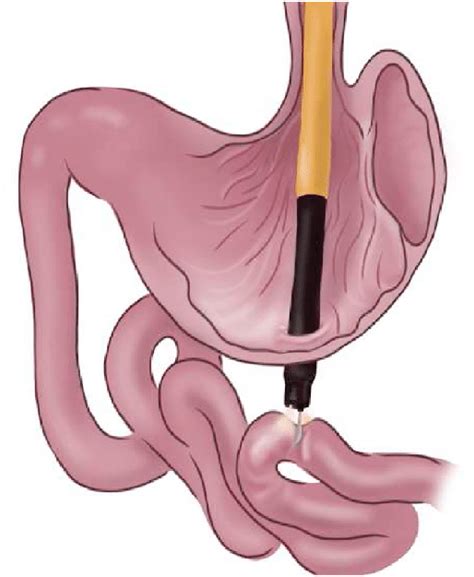 Schematic View Of Endoscopic Forceps Grasps Small Bowel Download