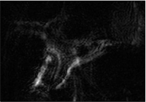 Degraded Image Quality Due To Respiratory Motion Artifacts And Poor