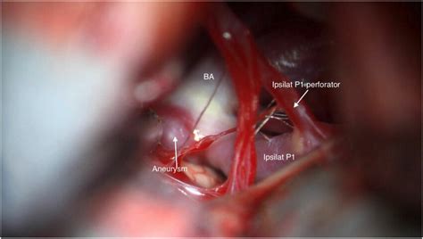 Visualization Of Basilar Tip Aneurysm Along With Other Vascular