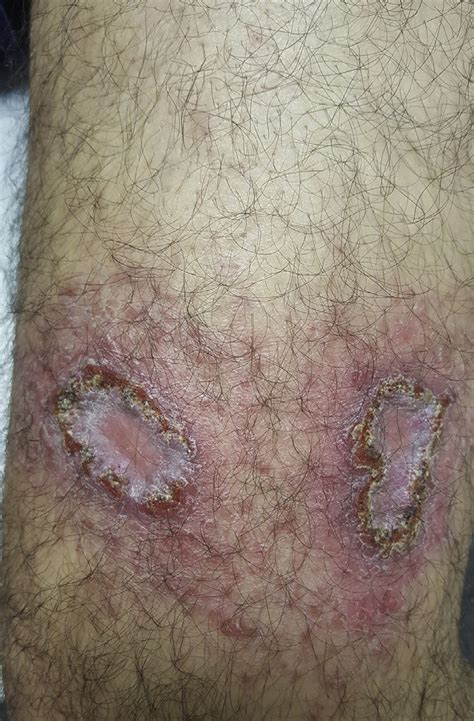 Eczematous Plaques With An Atrophic Center And No Ulceration On The