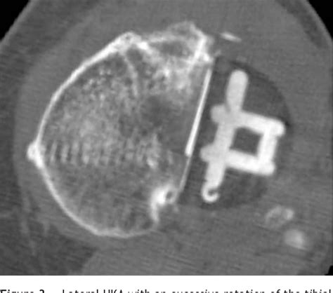 Figure 3 From Tibial Component Rotation Assessment Using CT Scan In Medial And Lateral