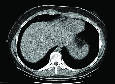 Axial Computed Tomography Scan Showing Unremarkable Insertion Of The