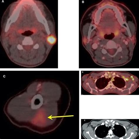 Forty Two Year Old Female With Unilateral Left Axillary Adenopathy