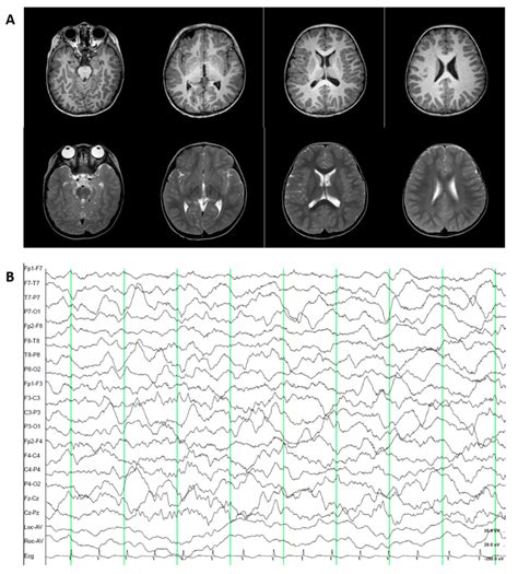 Brain Mri And Eeg Finding Of Patient 4 At 2 Years A The T1 First