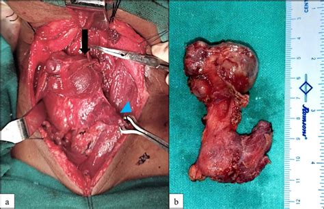 A Intraoperative Photo Depicting A Normal Left Lobe Thyroid Blue Download Scientific Diagram
