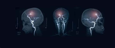 Best Stroke Hospital In Chennai Dr Vanchilingam Hospital