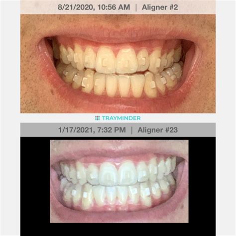 Happy With My Progress 10 More Trays To Go R Invisalign