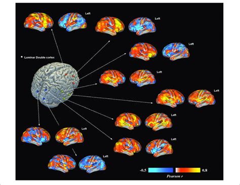 Voxel Wise Functional Connectivity Of Prefrontal Temporal And