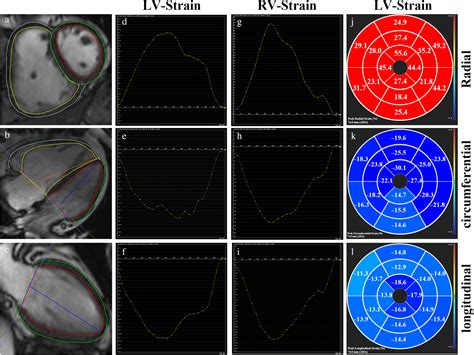 Biventricular Dysfunction And Ventricular Interdependence In Patients