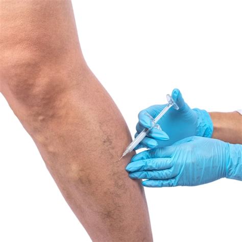 Varicose Veins Pielviva