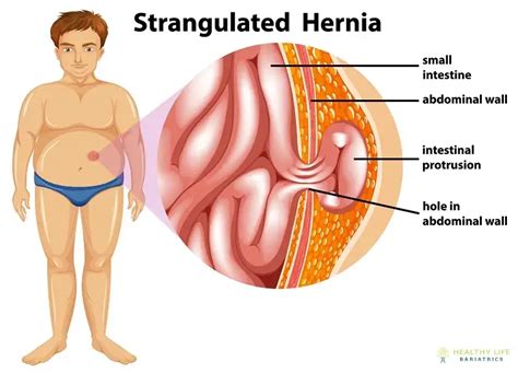Expert Hernia Surgery In Los Angeles Hernia Specialist