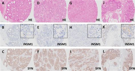 Insm1 Expression Groups In Conventional Crcs With Diffuse Expression Of Download Scientific