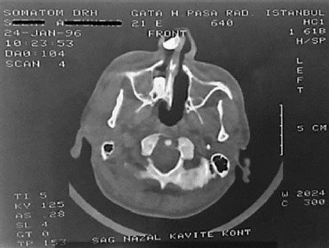 Computed Tomography Of A Patient With Right Choanal Atresia Shows An