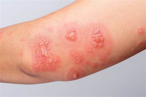 Ingrown Hair Or Herpes Symptoms Diagnosis And Treatment